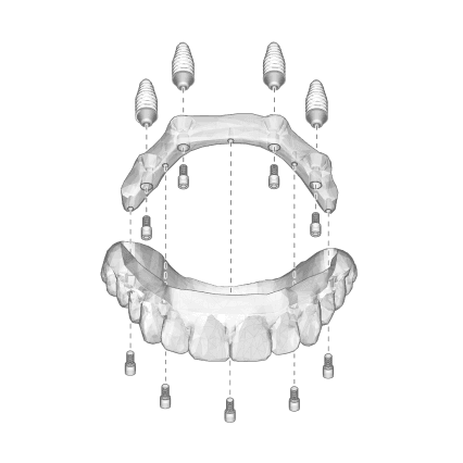 Digital Full Arch